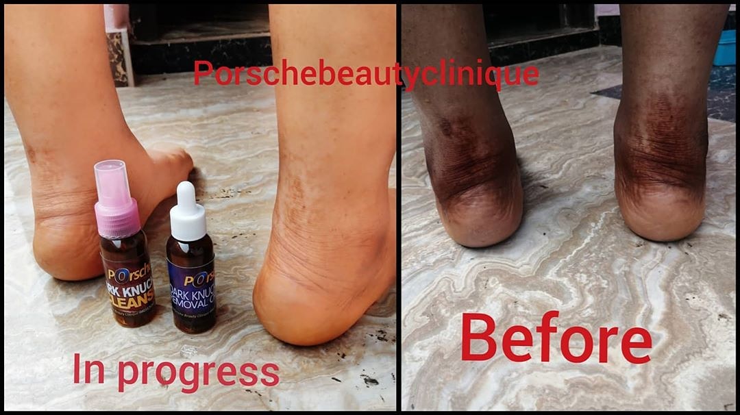 Instant Knuckle Removal Set « Porsche Beauty Clinique